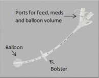 PEG, PIGG and RIG | North Bristol NHS Trust